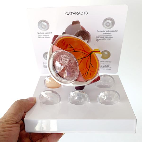 China Human Eyeball Cataract Anatomy Medical Science Human Eye Anatomy ...